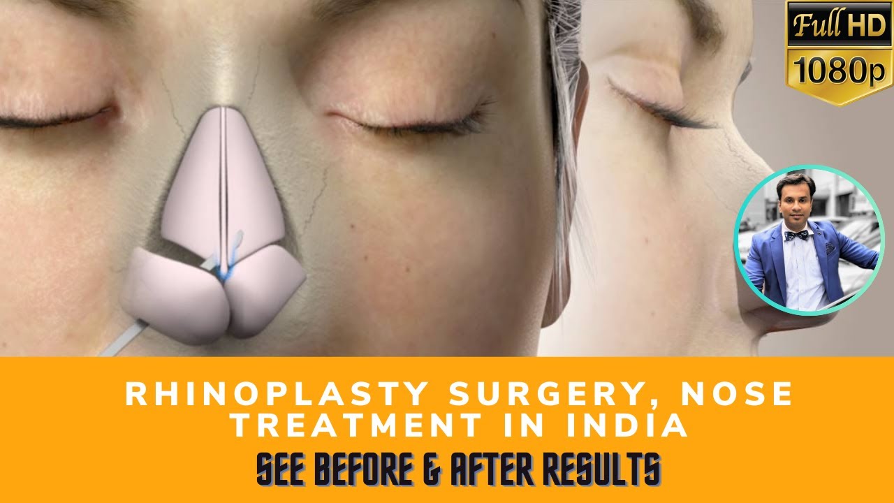 Rhinoplasty, Nose Surgery (Nose Job) in India | Before After Results ...