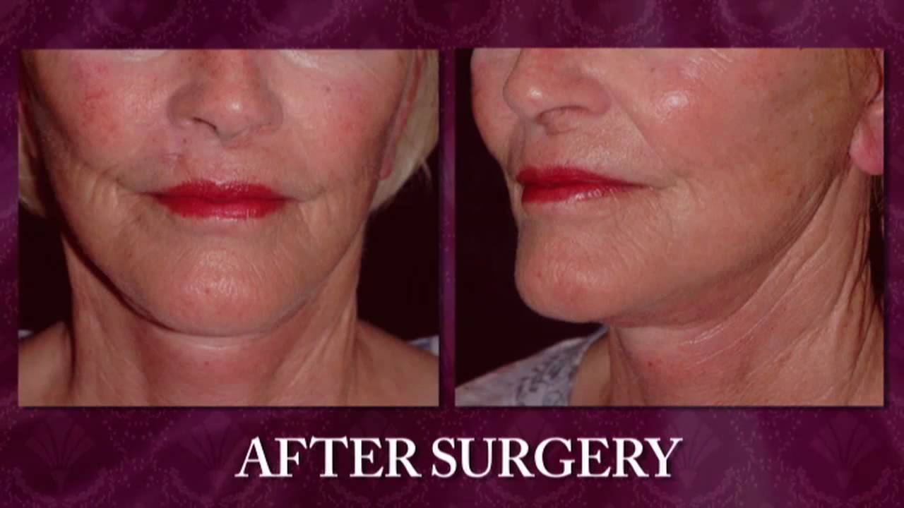 Dimple Creation, Dimpleplasty in Athens, Buckhead, Atlanta and Eatonton ...