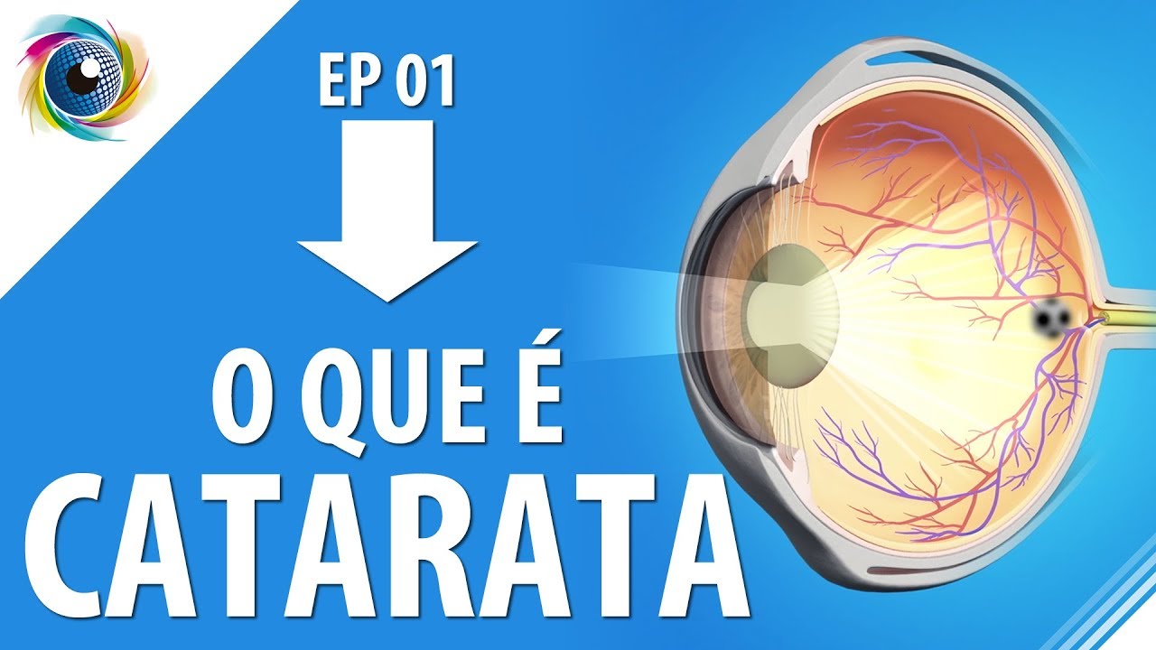 O que é a Catarata - EP01 - Checkup dos Olhos - YouTube