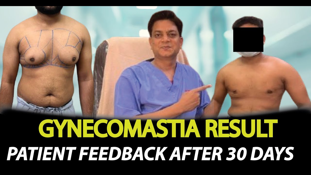 Gynecomastia Result After 1 Month | Rejuvena Cosmo Care | Dr. Deepesh Goyal - YouTube