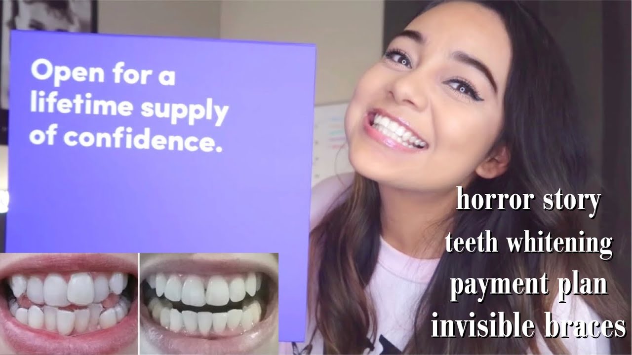 Smile Direct Club Aligners Unboxing, Review + Update! *Teeth Whitening ...