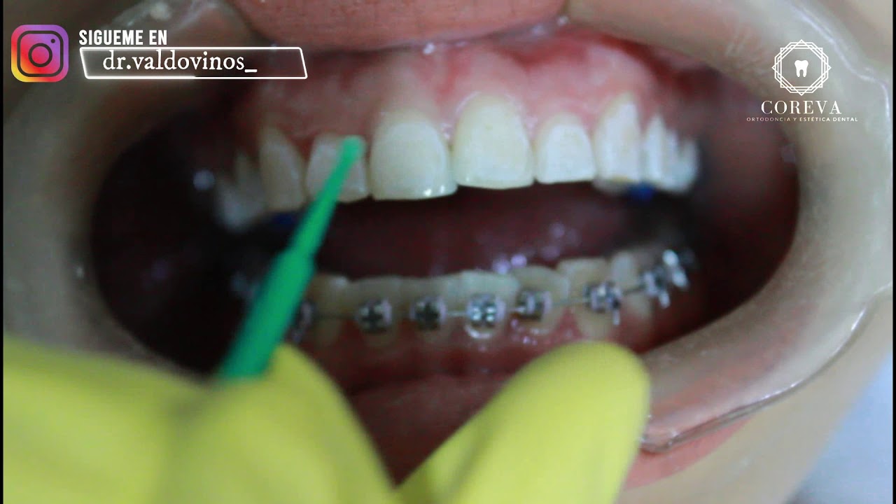 Colocación de Brackets con técnica Indirecta - YouTube