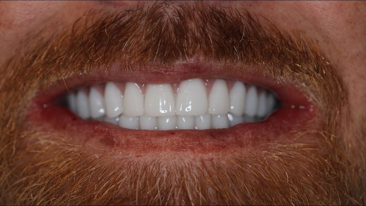 Dental Implants - YouTube