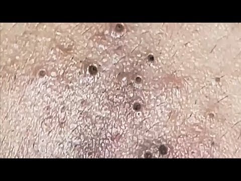 Satisfying every day /Blackhead removal /Acne treatment /Pimple popping ...
