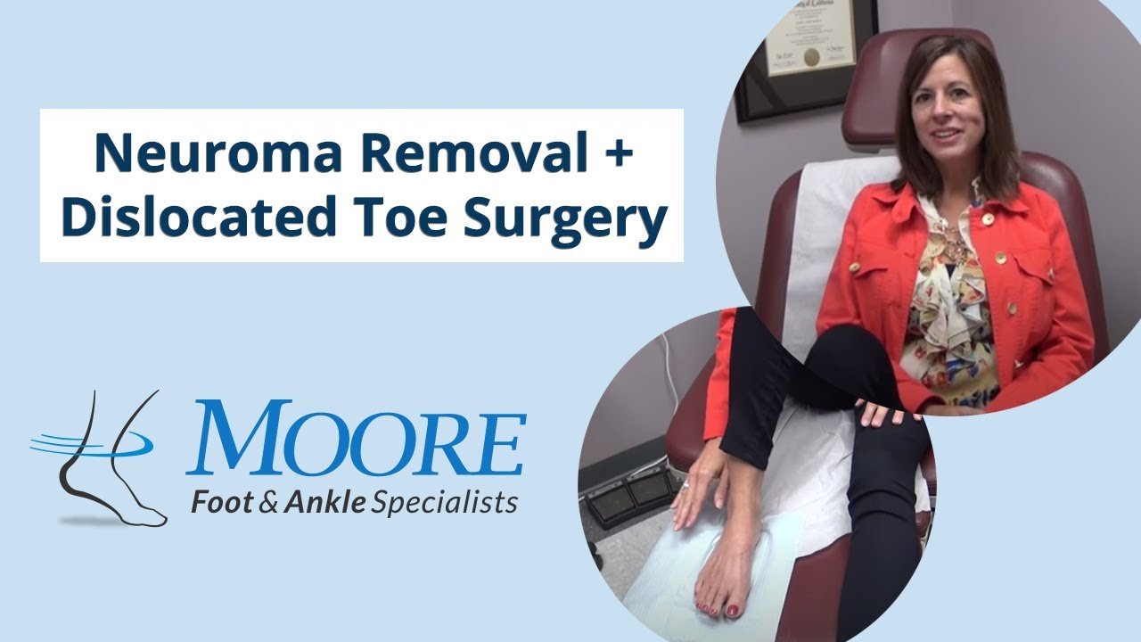 Neuroma Removal and Dislocated Toe Surgery: Patient Testimonial | Moore ...