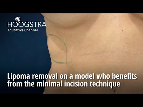 Lipoma removal on a model who benefits from the minimal incision ...