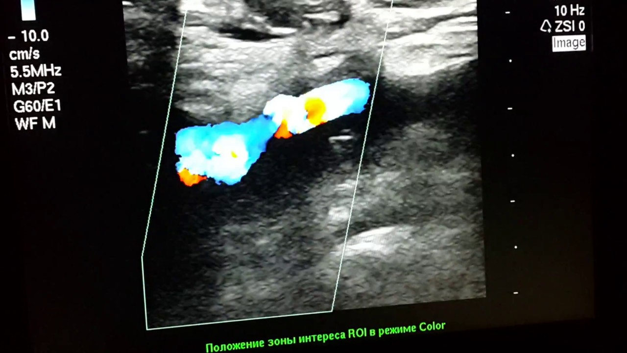 Ultrasound May Thurner Syndrome Deep Vein Iliofemoral Trombosis Youtube