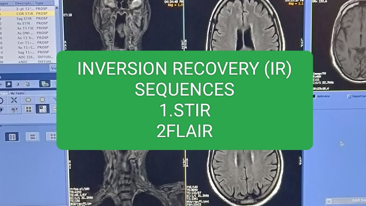 MRI Inversion Recovery sequences Stir and Flair ko kese phchane @Mri ...