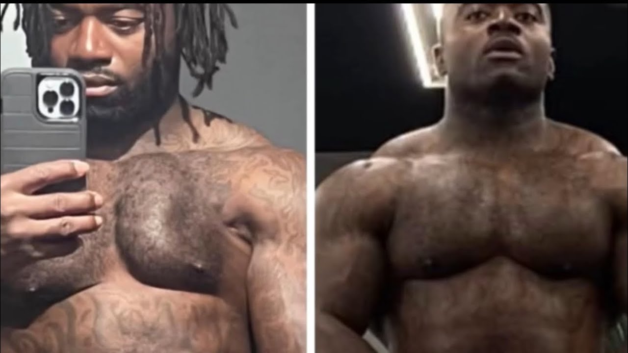 From Injury to Recovery: Ultra-Chronic Pec Repair- Patient Testimonial ...