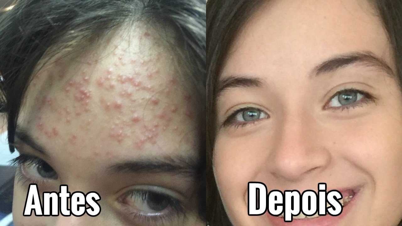 Iniciando o tratamento com Roacutan - Carol Santina - YouTube