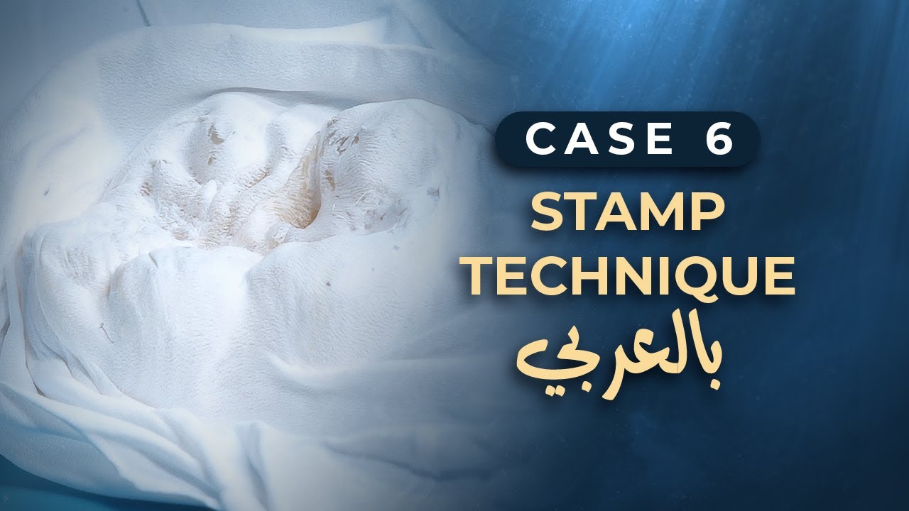 Stamp Technique بالعربي I Case 6 - YouTube