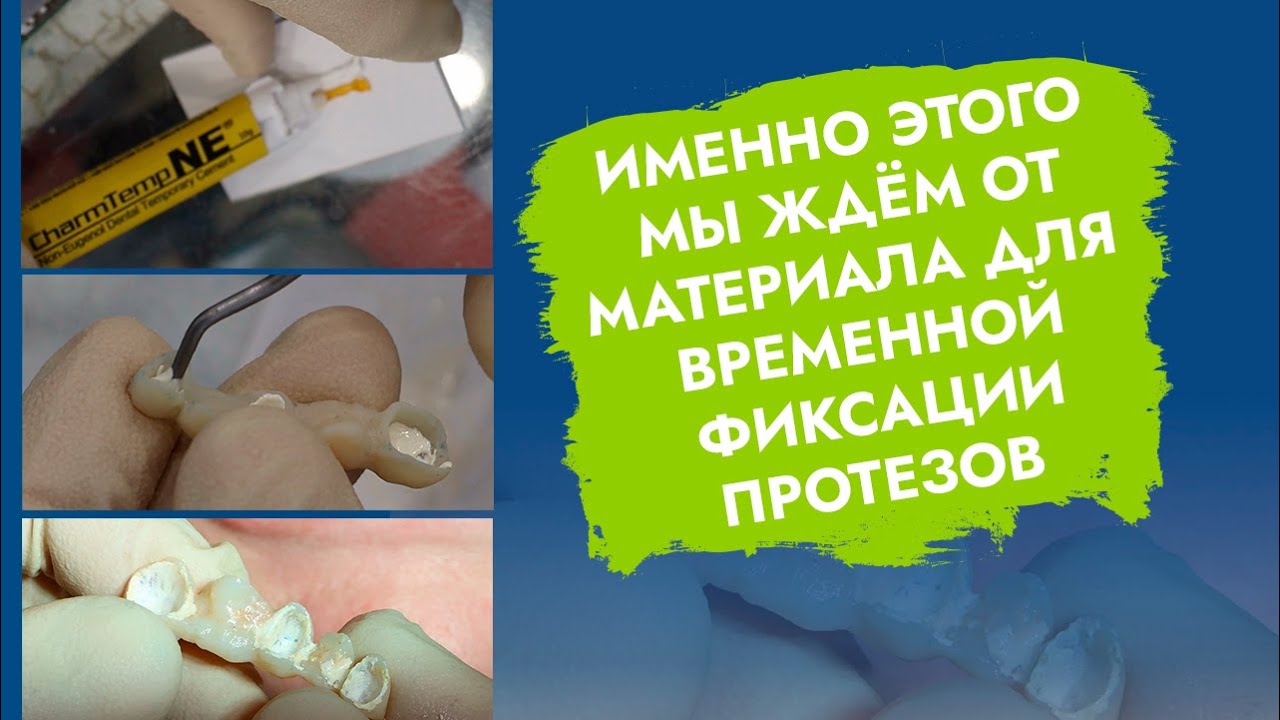Временная фиксация несъемных протезов. CharmTemp NE. - YouTube