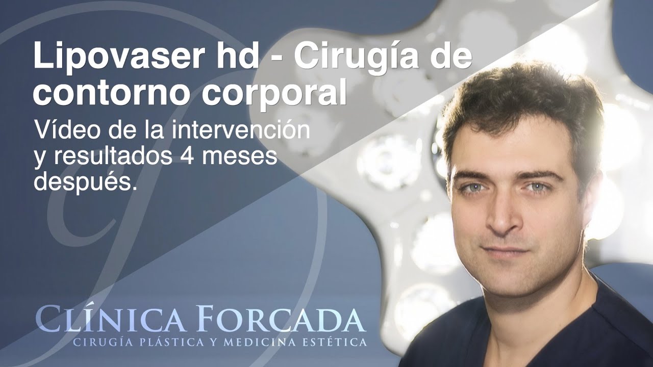 Lipo vaser Hd Madrid - YouTube