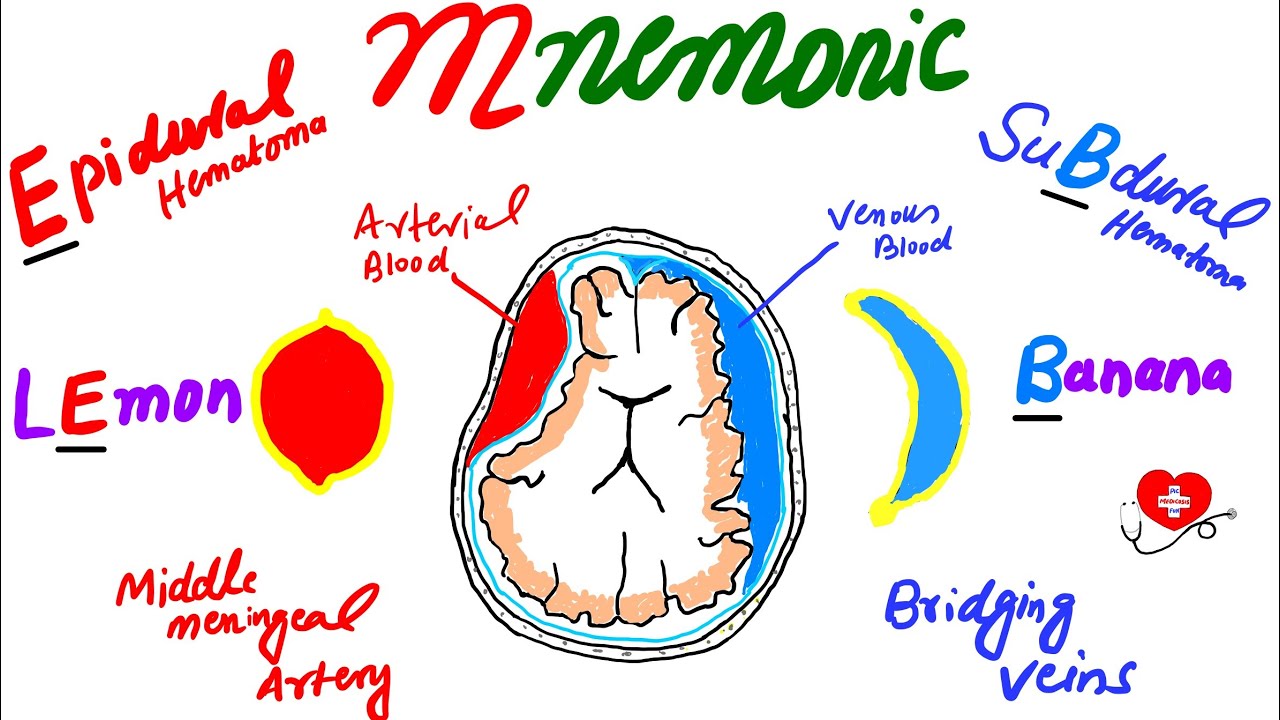 Extradural hematoma vs Subdural hematoma mnemonic for plab - YouTube