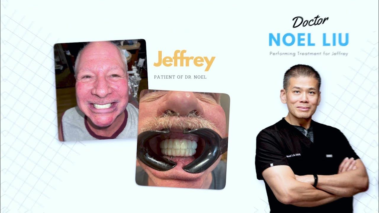 From Collapsed Bite to Confident Smile: Fixed Full Arch Journey | Dr. Noel Liu | Secure Dental ...