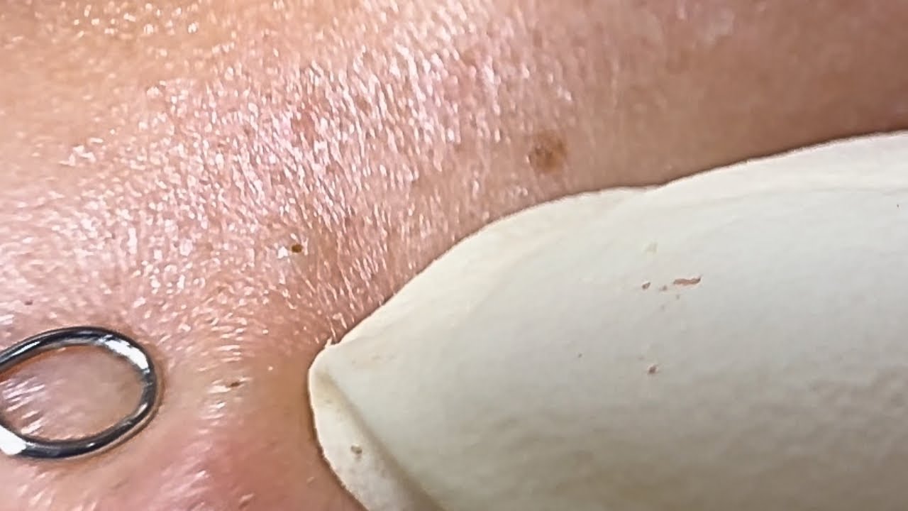 Extraction of forehead and nose pimples:Relax with bye pimple💜 - YouTube