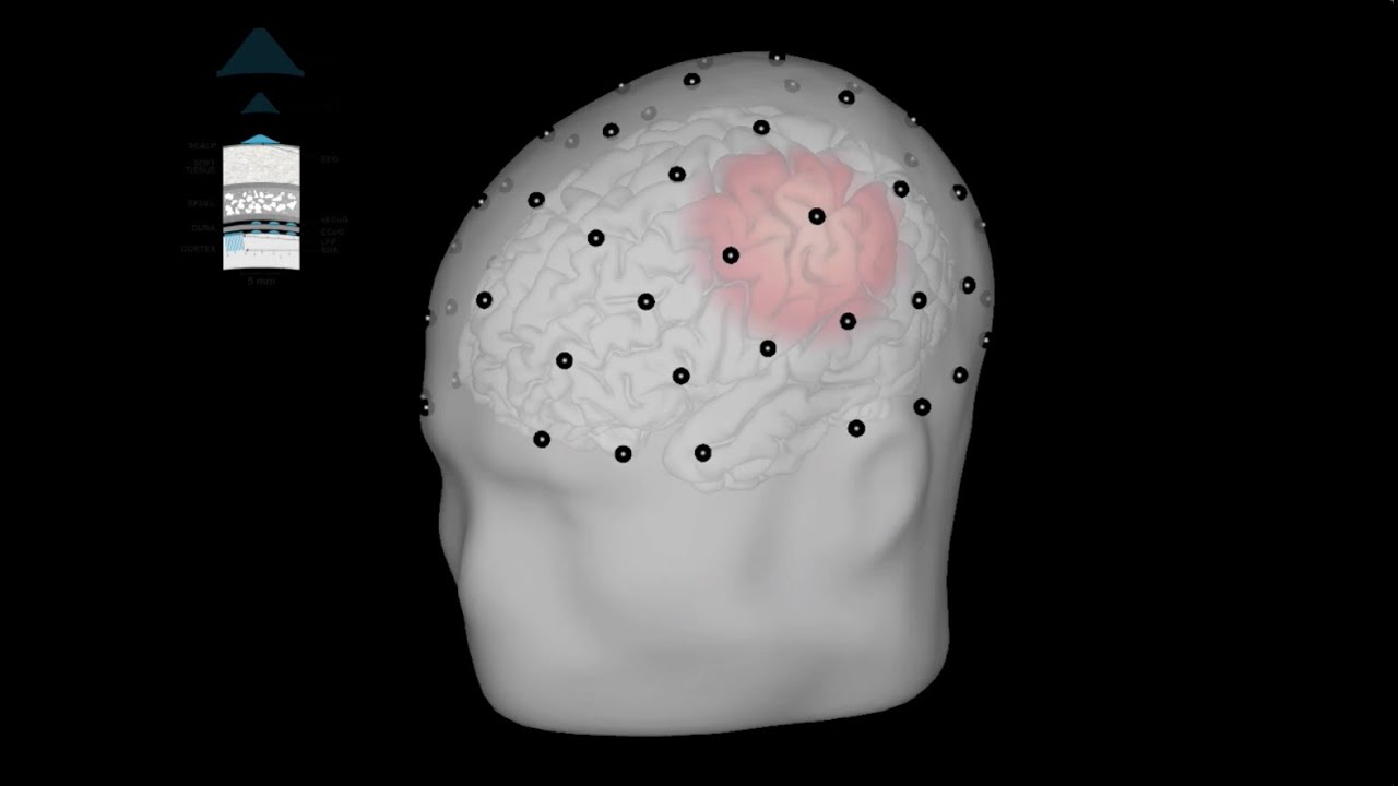 Intro to EEG and ECoG: Applications in Sleep, BCI, and Brain Mapping ...