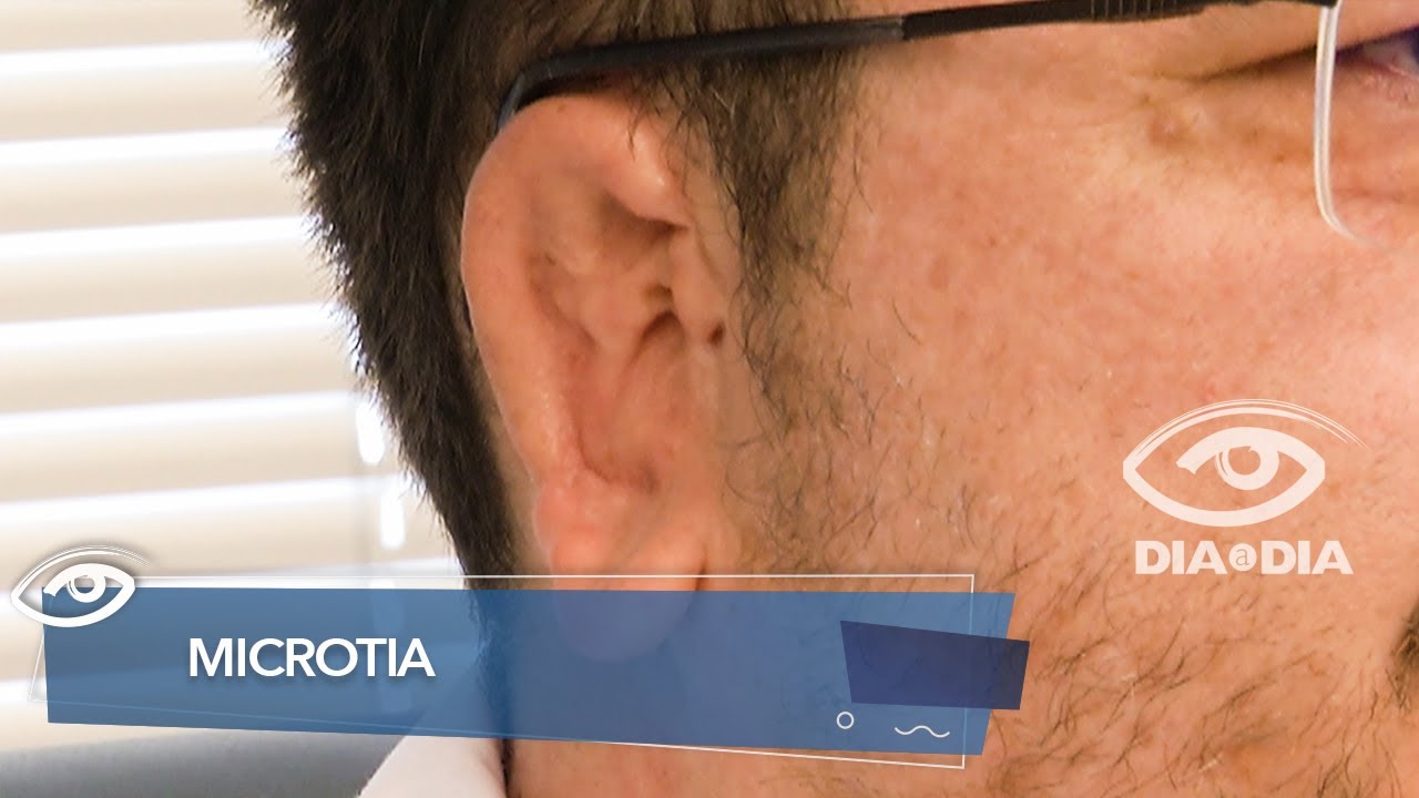 Microtia - 2da Parte - Día a Día - Teleamazonas - YouTube