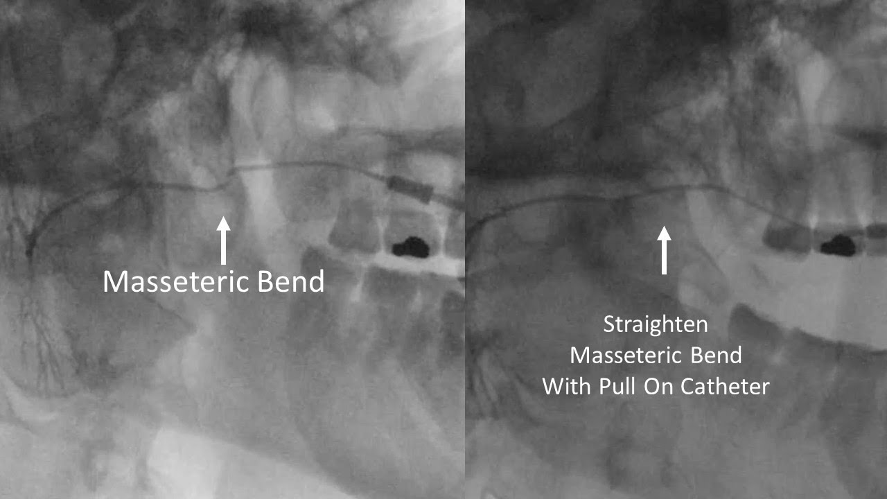 Stensens Duct Straighten Masseteric Bend - YouTube