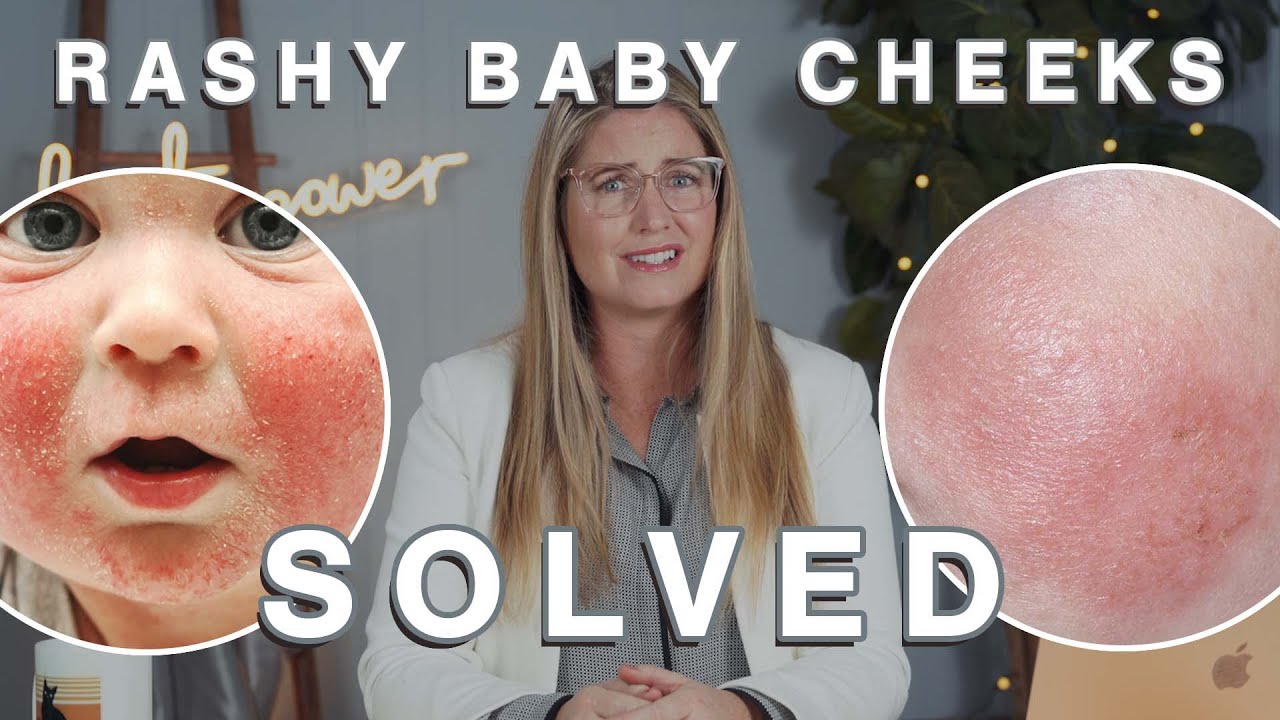 Red Rashy Baby Cheeks | Skin Deep - YouTube
