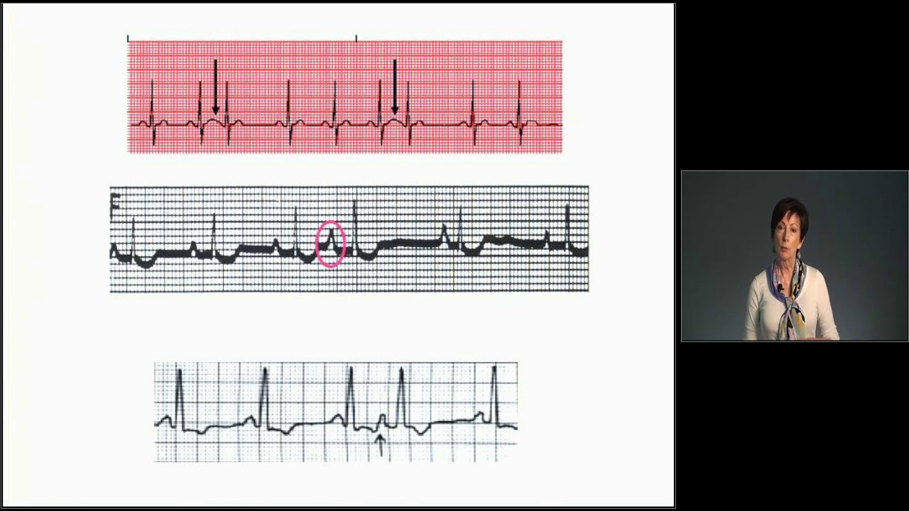 ECG Interpretation: Atrial Rhythms - MED-ED - YouTube