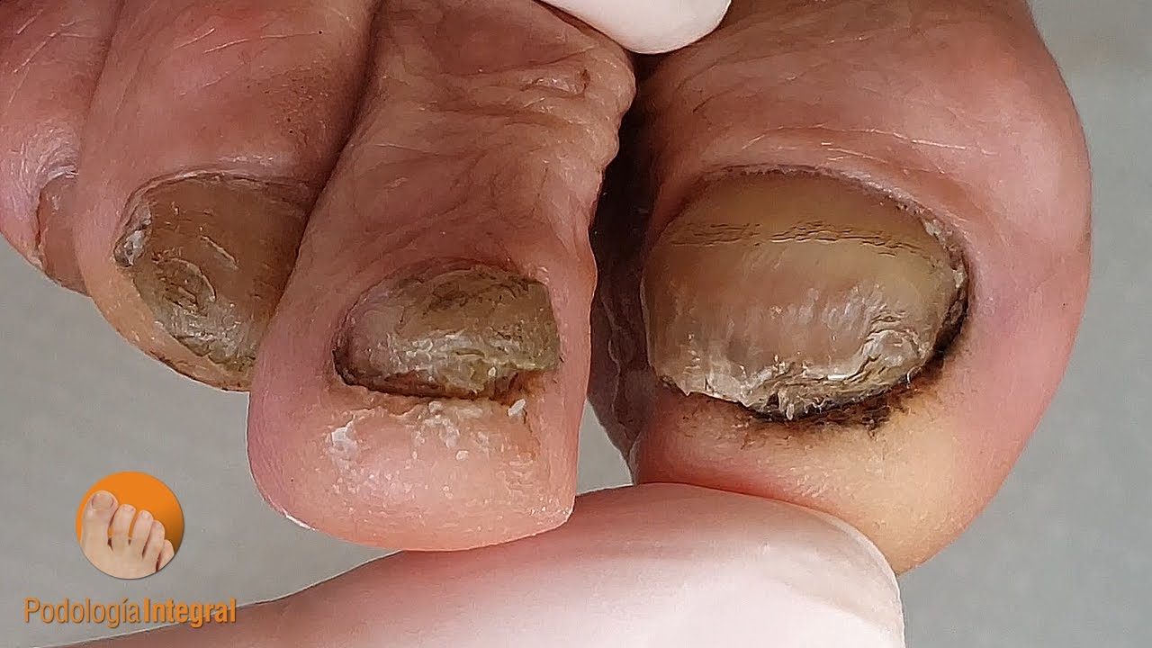 94 years older adult who is coming for the 2nd time for a complete ...