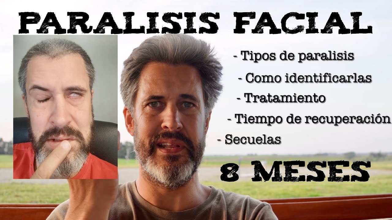 RAMSAY HUNT - PARALISIS FACIAL - PARALISIS DE BELL - BELL´S PALSY - YouTube