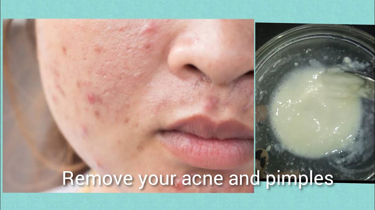 How to stop pimples & acne fast clear skin hack ☺ NO PIMPLES NO ACNE ...