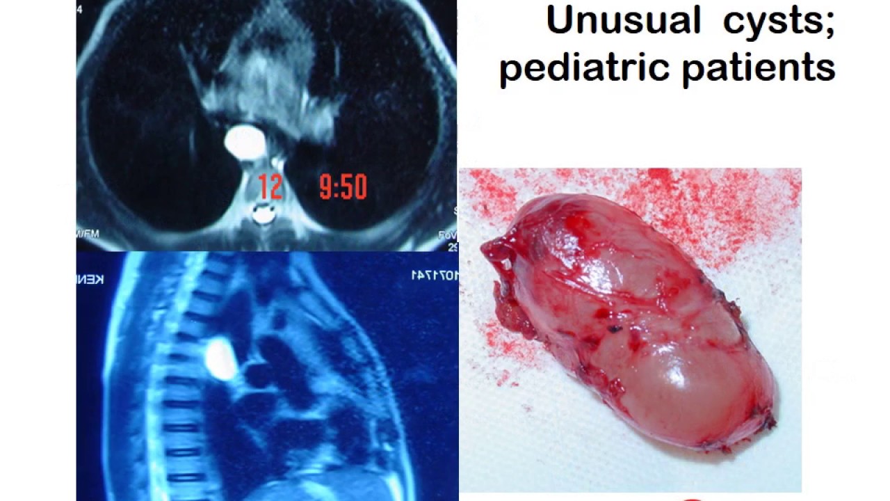 Robotic Resection of Unusual Mediastinal Masses - YouTube