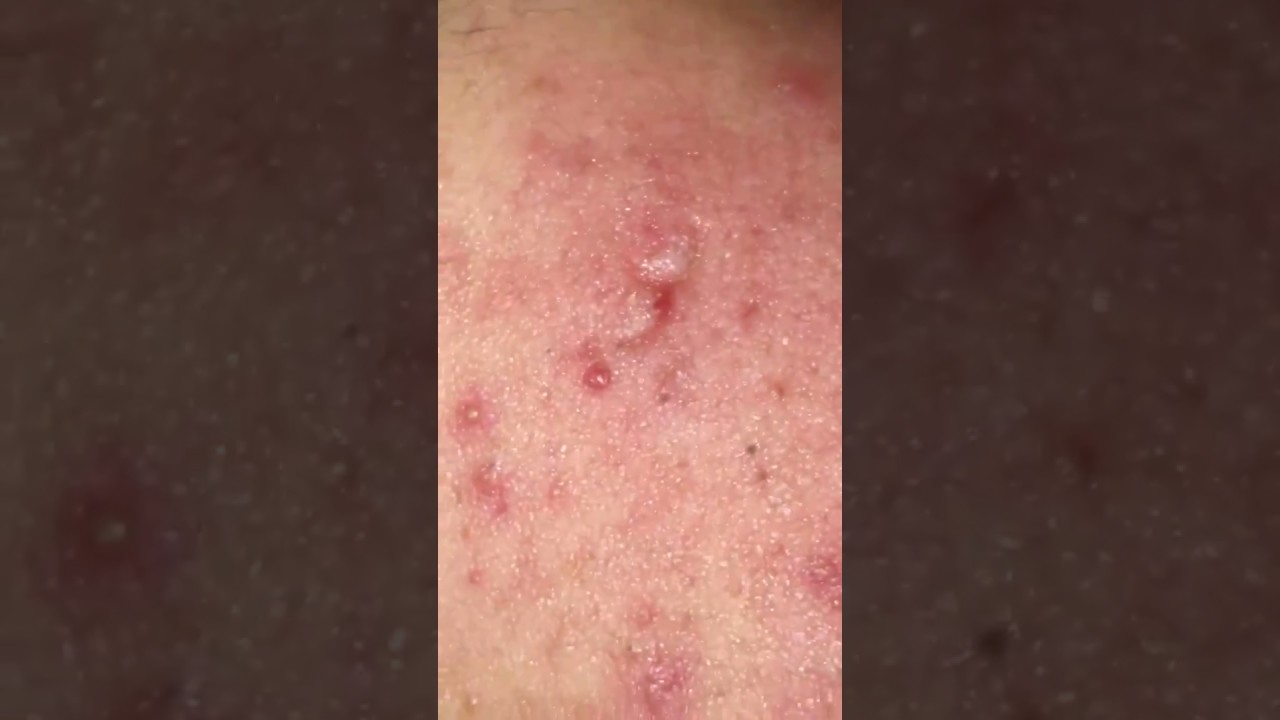 Pimples ,Cystic , Acne And Blackheads Extraction Acne Treatment On Face ...