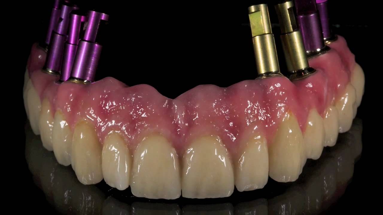 Dentallabor Christian Rothe HD 2009 - YouTube