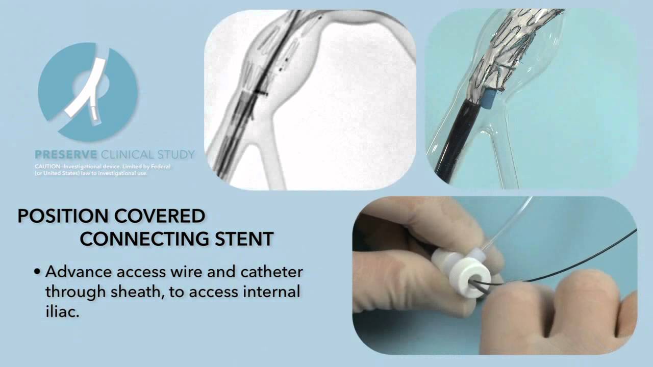 Cook zenith ramificada - YouTube