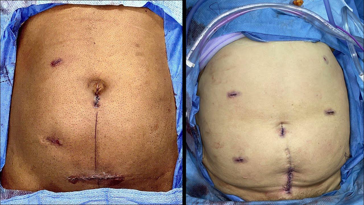 Laparoscopic Sigmoid Colectomy For Diverticular Disease Clinical Scenarios And Technical