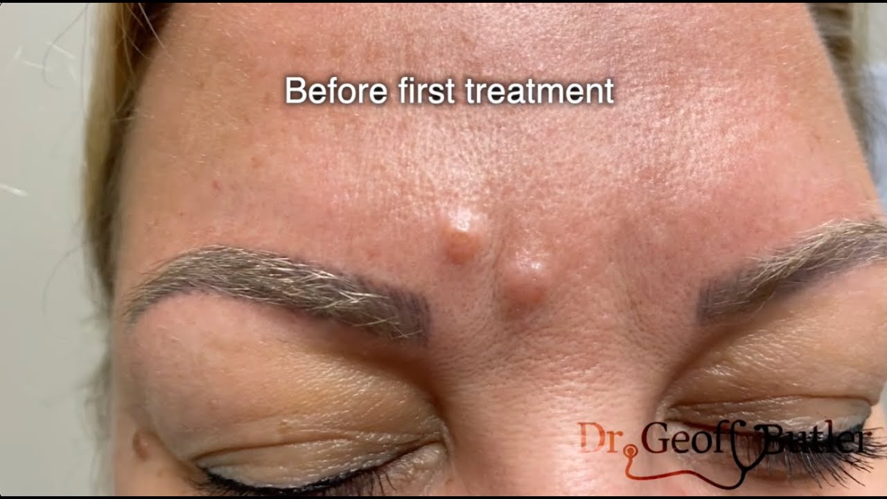 An alternative way to remove facial lesions without scarring - using ...