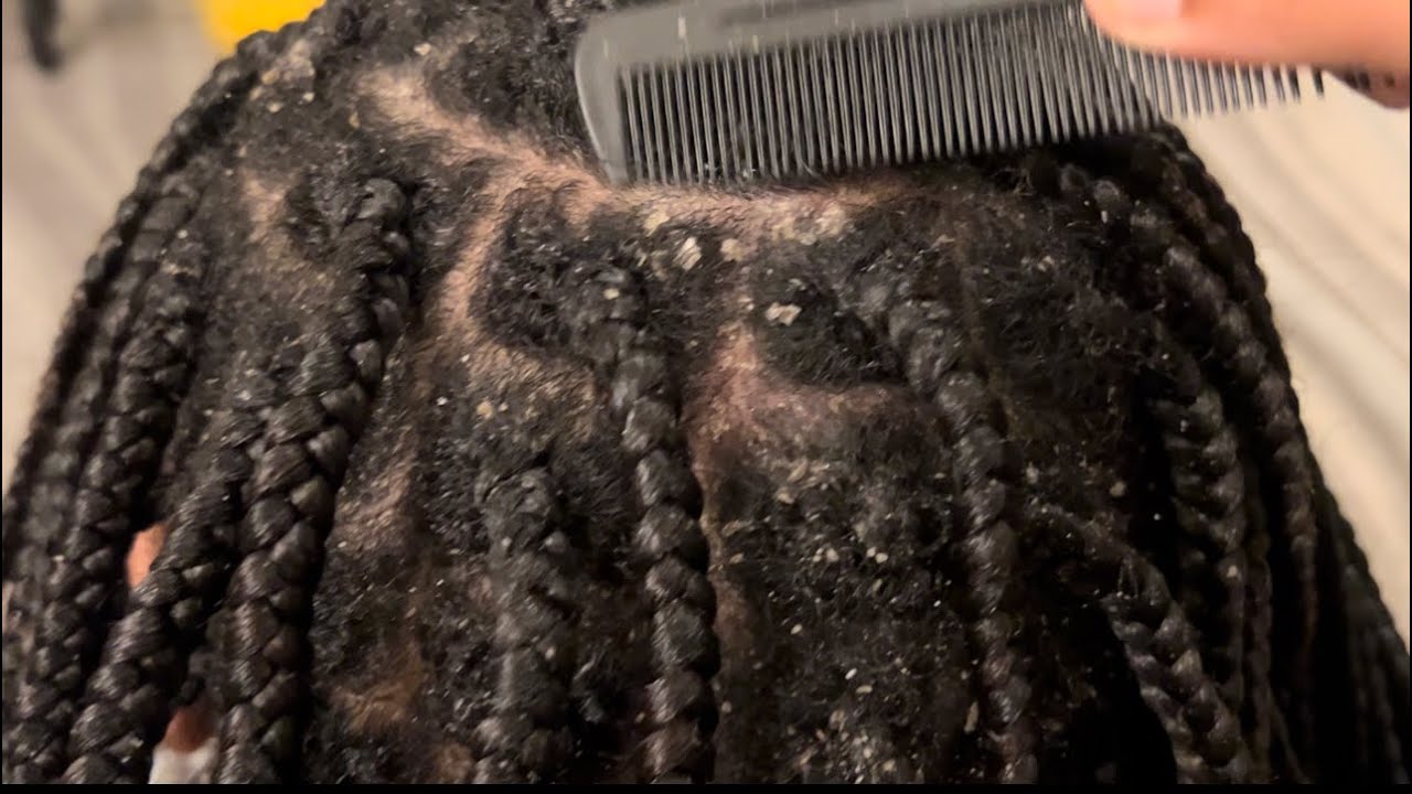Scratching bad dandruff #subscribe #dandruff #scratchingasmr #asmr ...