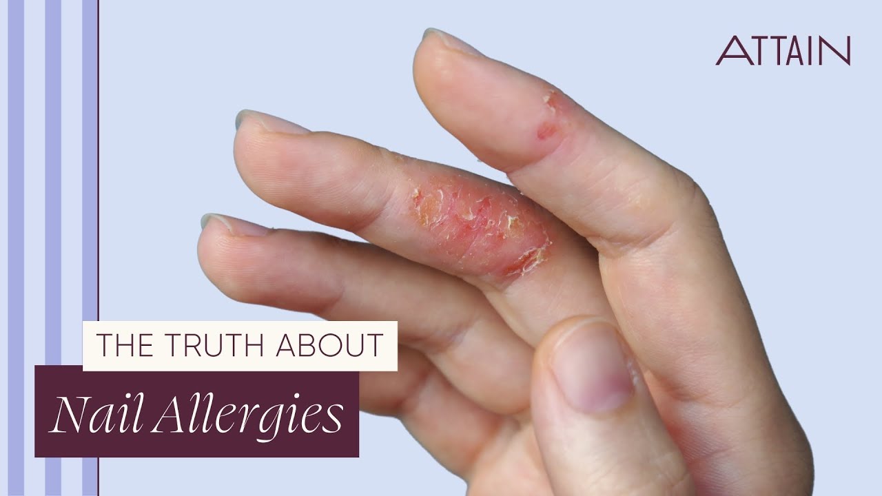 The Truth Behind Nail Allergies | Causes, Symptoms, and Best Solutions ...
