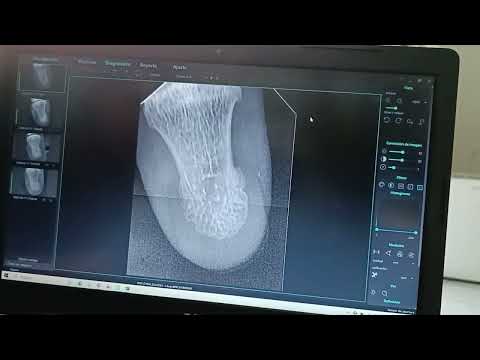 tutorial i sensor Dba by woodpecker - YouTube