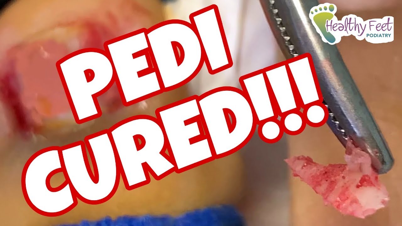 Ingrown Toenail After A Pedicure. Ingrown Nail Removal. - YouTube