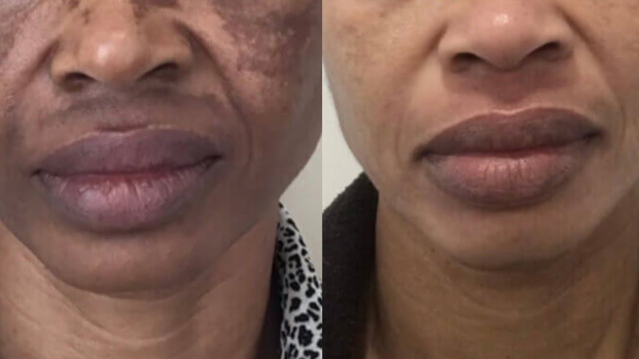 Only two ingredients remove hyperpigmentation and dark spots - YouTube