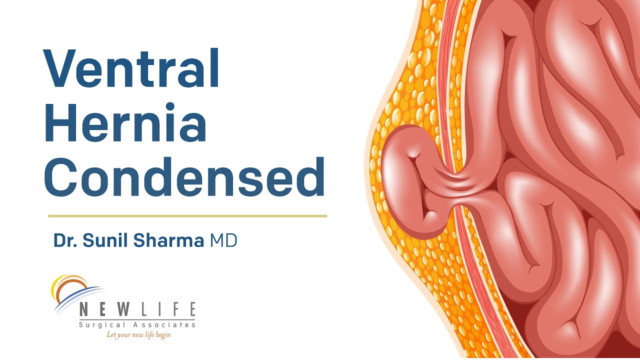 Ventral Hernia Condensed Youtube