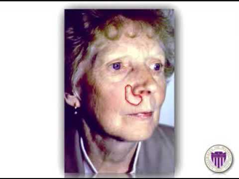 THE SUBMENTAL FLAP - YouTube