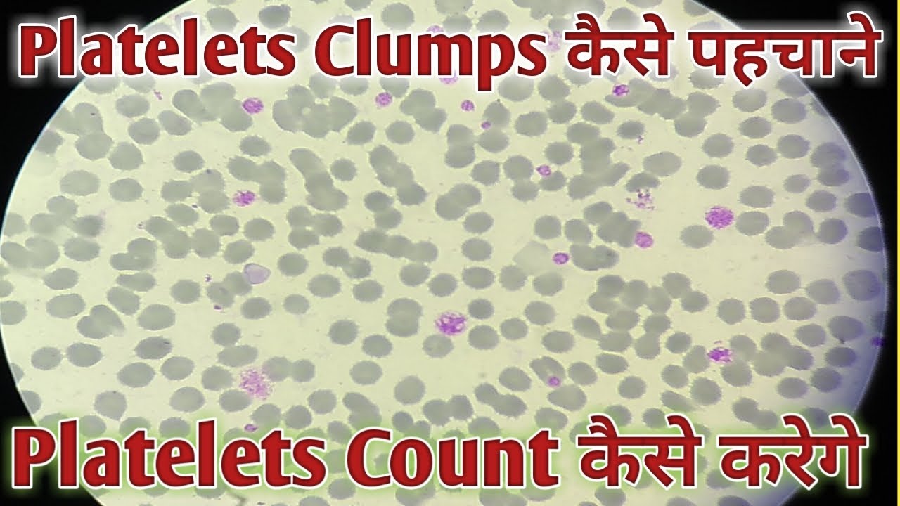 Platelets Clumps How To Identity Platelets Clumps platelets-clumps-how-to-identity-platelets-clumps