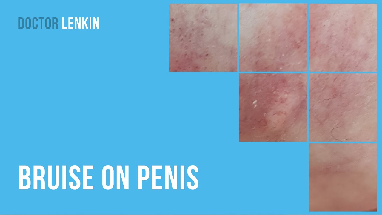 🙁 Bruise on penis - YouTube