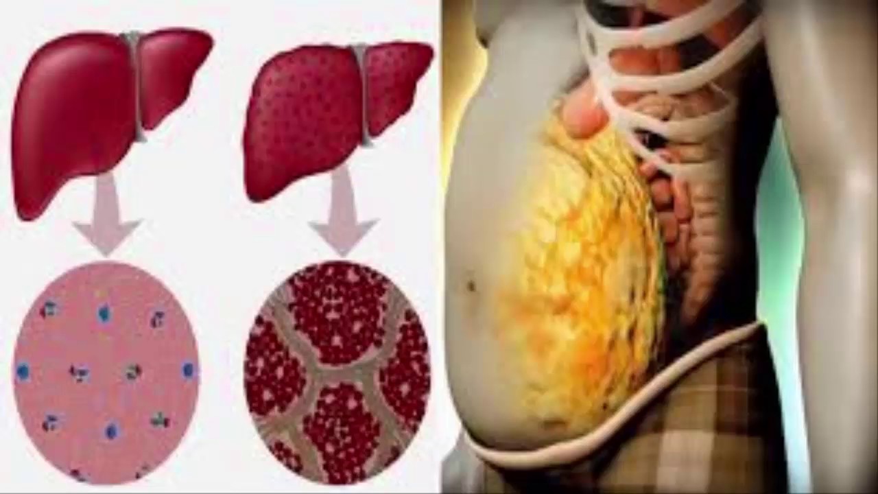 How to Unclog and Detox Your Stressed Out Liver in Just 72 Hours - YouTube