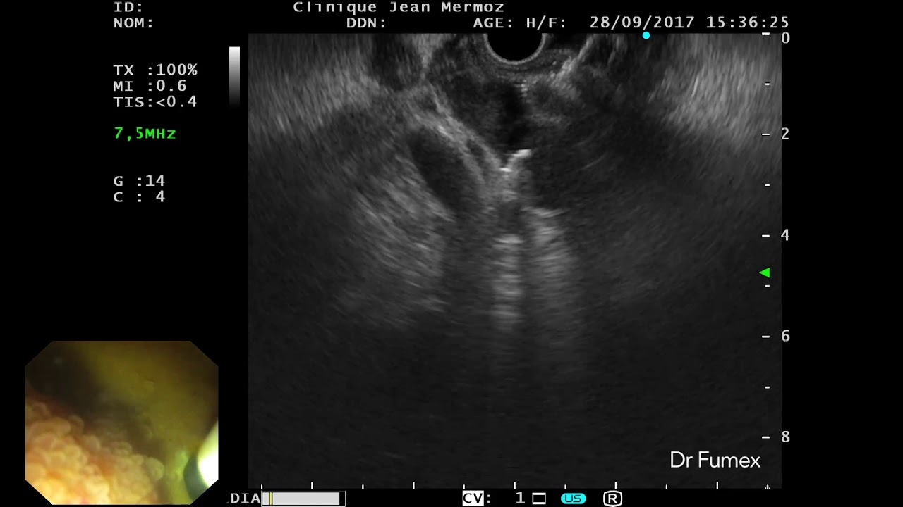 Cholédoco-duodénostomie endoscopique écho-guidée avec une prothèse d ...