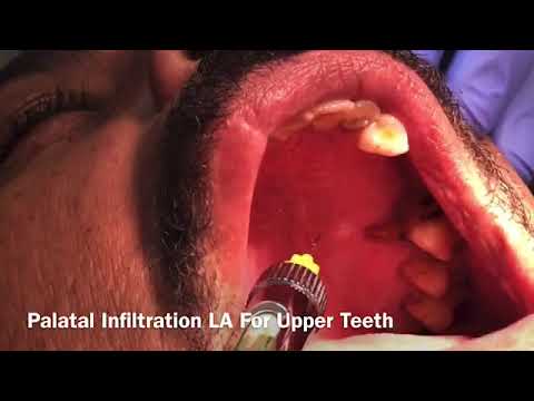 Palatal Infiltration LA For Upper Teeth - YouTube