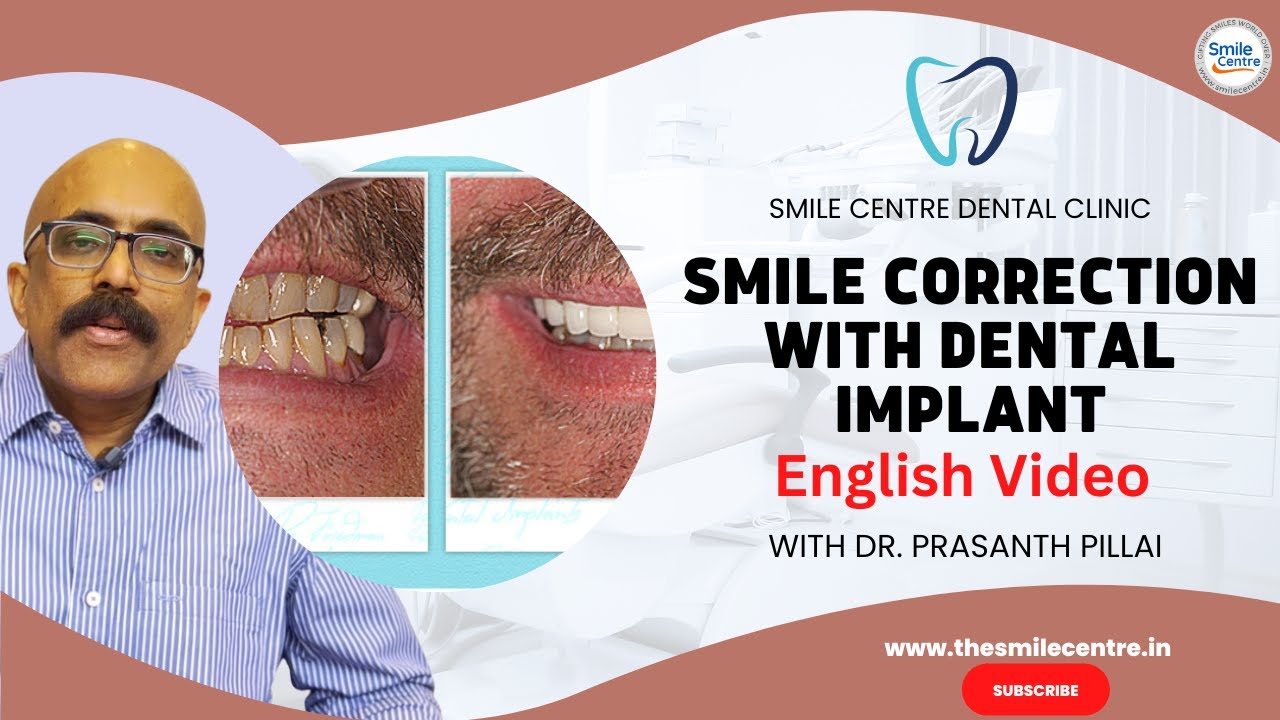 Smile correction with Dental Implant | English Video | Dr. Prasanth ...