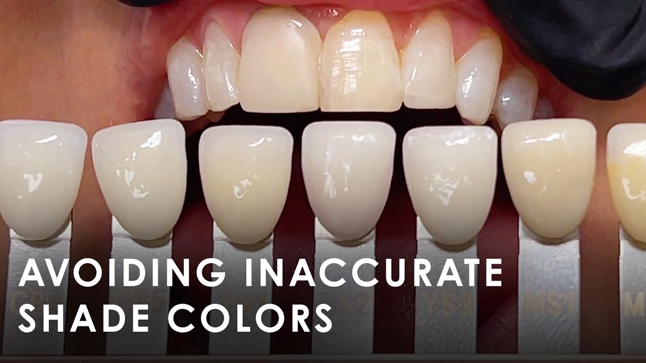 How to Avoid Inaccurate Tooth Shades - YouTube