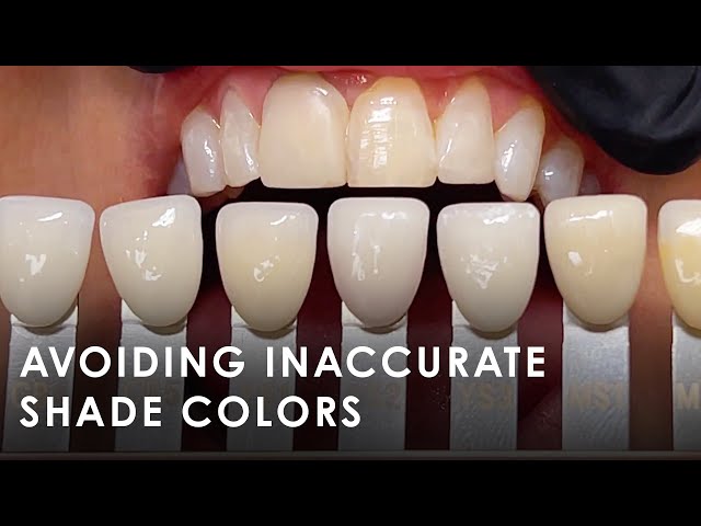 Tooth Color Chart B1 Aesthetic Update The Art Of Clinical Shade