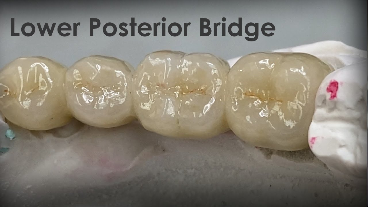 How to Make an Exceptional Lower Posterior Bridge - YouTube